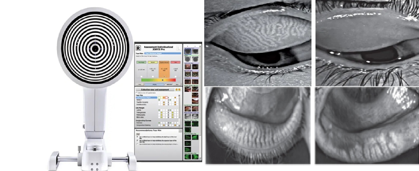 Comprehensive Dry Eye Test & Treatment - Happy Eyes